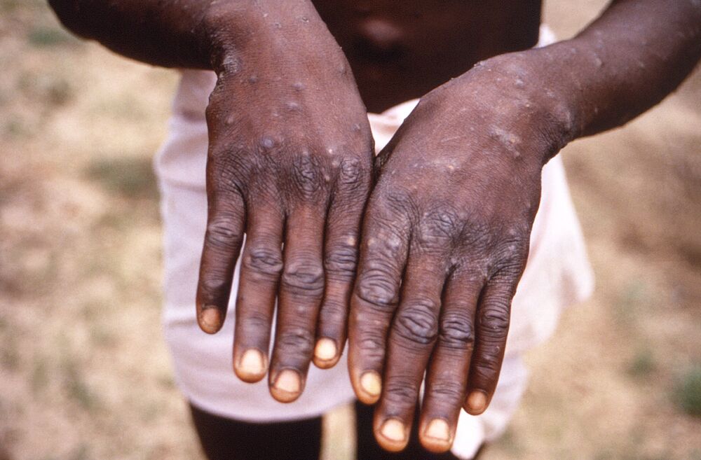 HK mandates declaration of monkeypox cases, announces three-tier ...