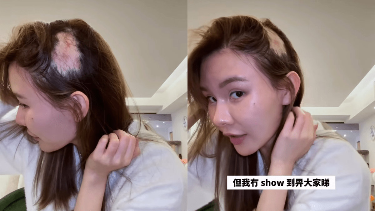 Controversial influencer Rachel Chung reveals severe hair loss, opens ...
